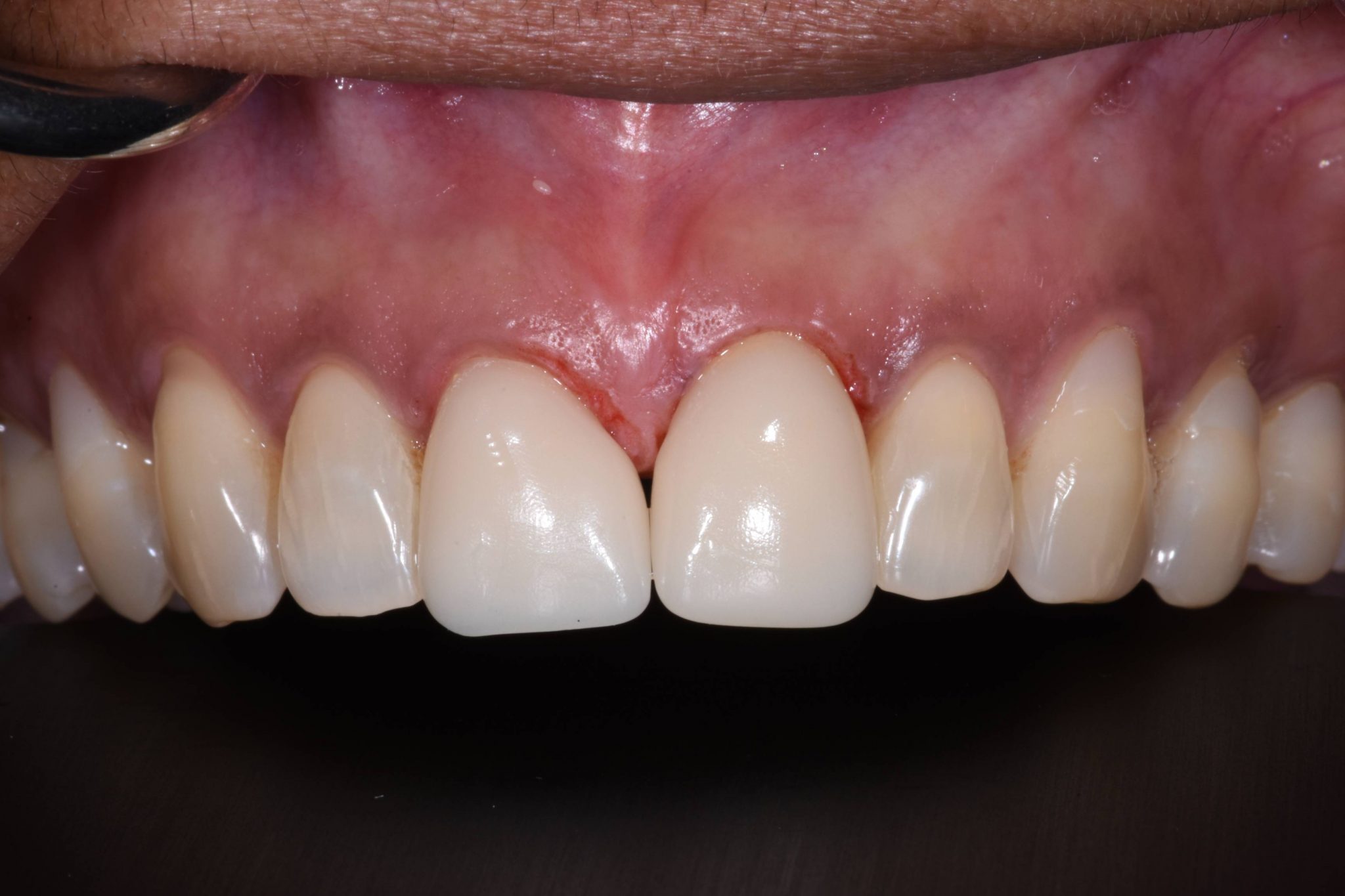 Dental Veneers Gallery in Aldie VA | Before and After Dental Veneers